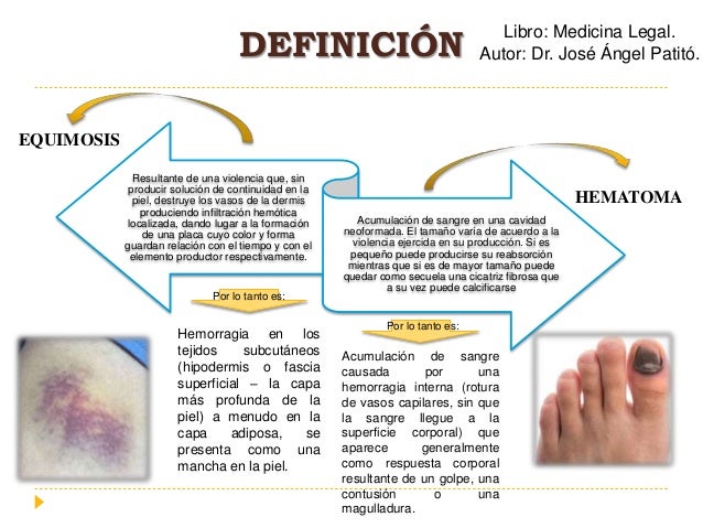 Equimosis O Hematoma