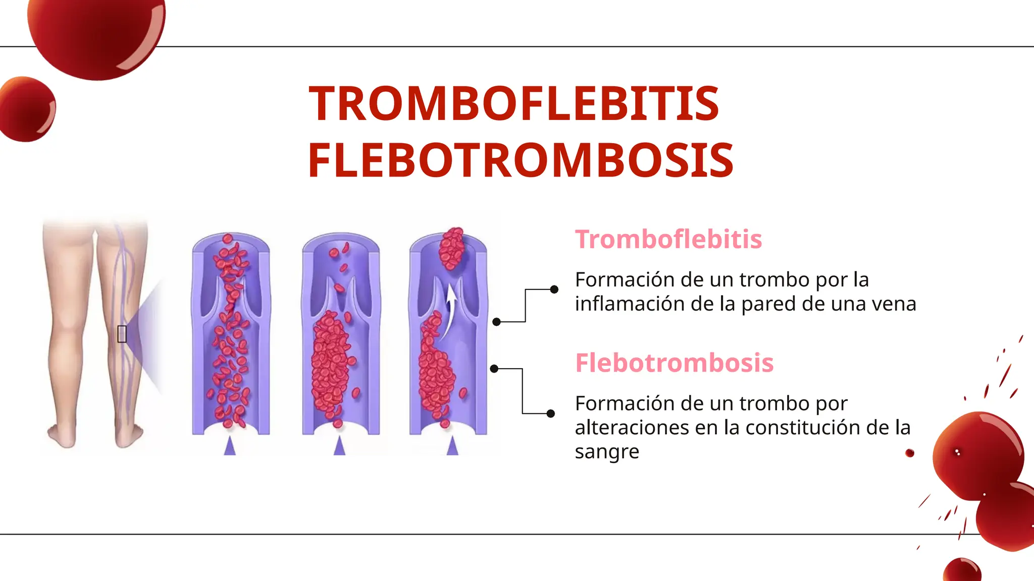 Diferencias flebotrombosis y tromboflebitis.pptx