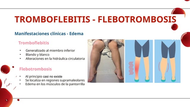 Diferencias flebotrombosis y tromboflebitis.pptx
