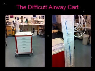 Difficult airway management for nursing staff | PPT