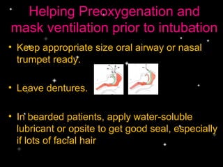 Difficult airway management for nursing staff | PPT