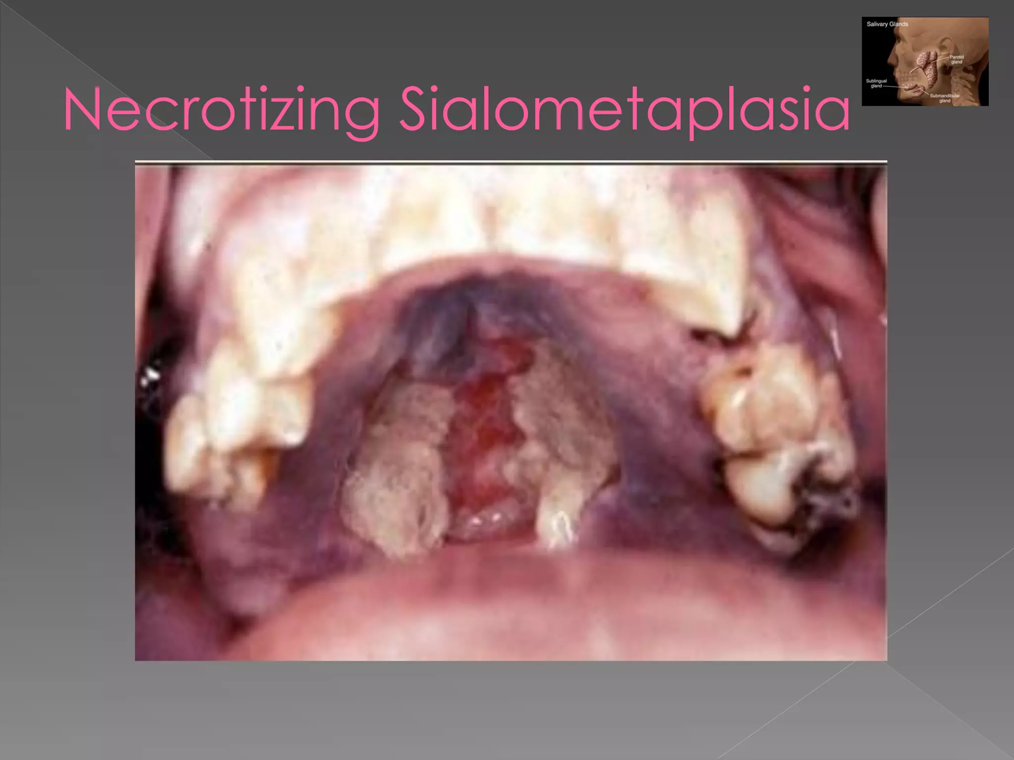 Differential Diagnosis of Salivary Gland Lesions | PPT