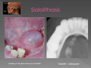 Differential Diagnosis of Salivary Gland Lesions | PDF