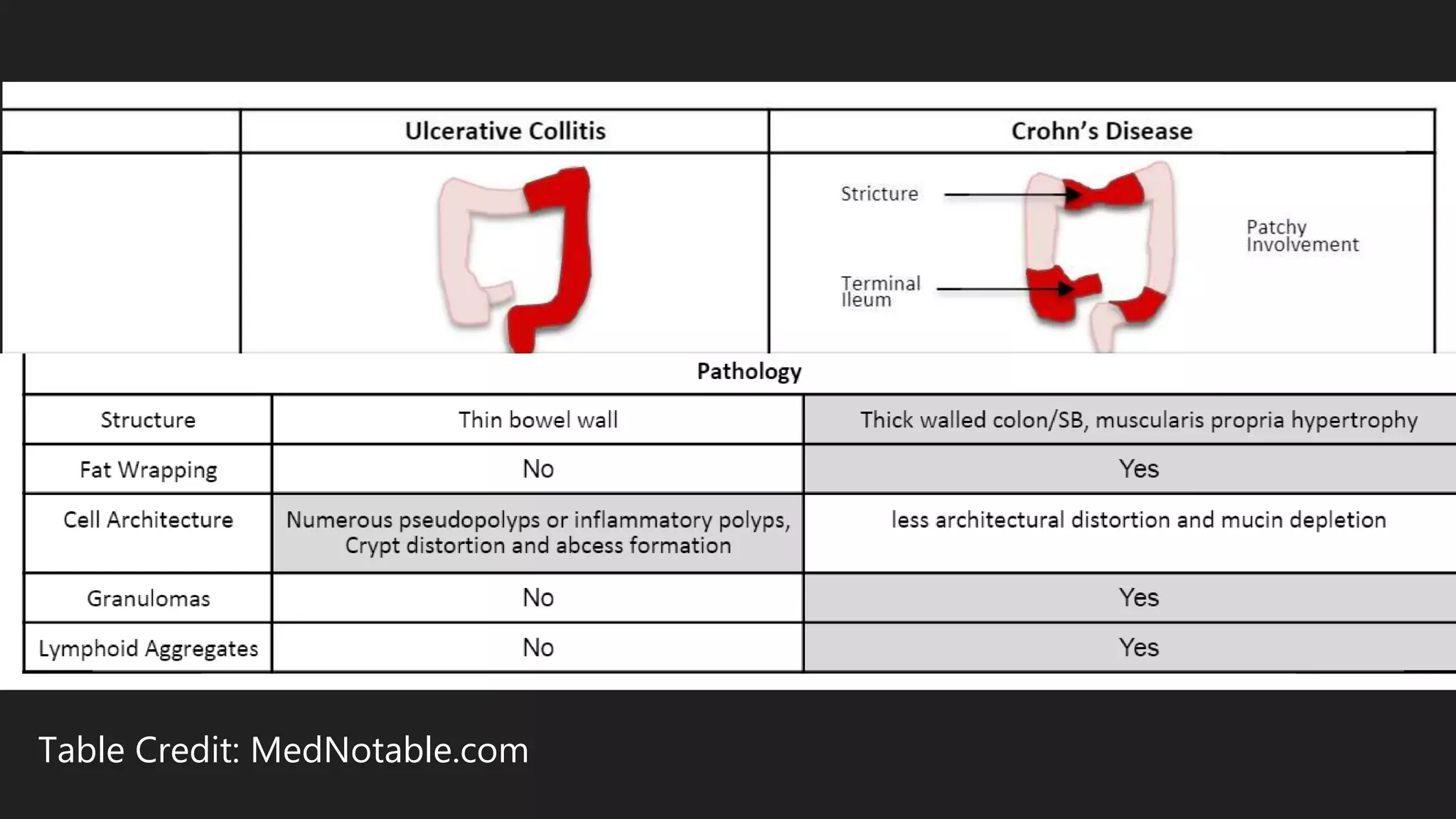 Difference between Crohn's Disease and Ulcerative Colitis | PPTX