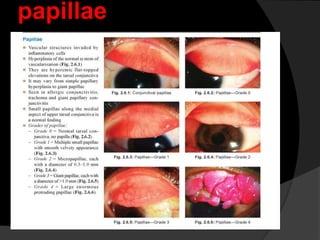Difference between follicles & papillae. | PPTX