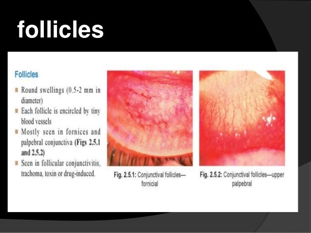 Difference between follicles & papillae.