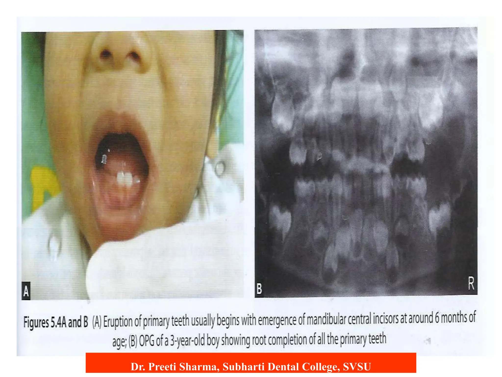 Difference between permanent and deciduous teeth.pdf