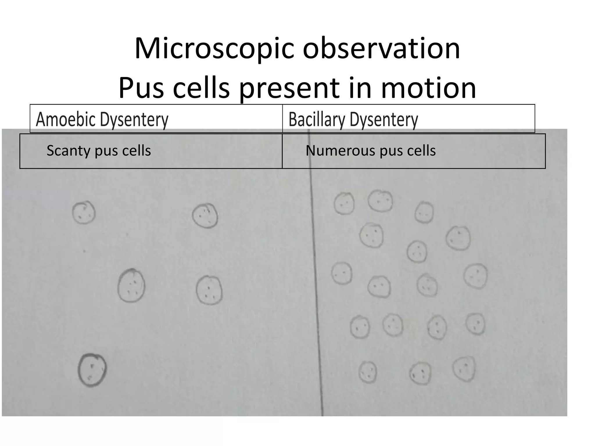 Differences between amoebic and bacillary dysentery | PPTX