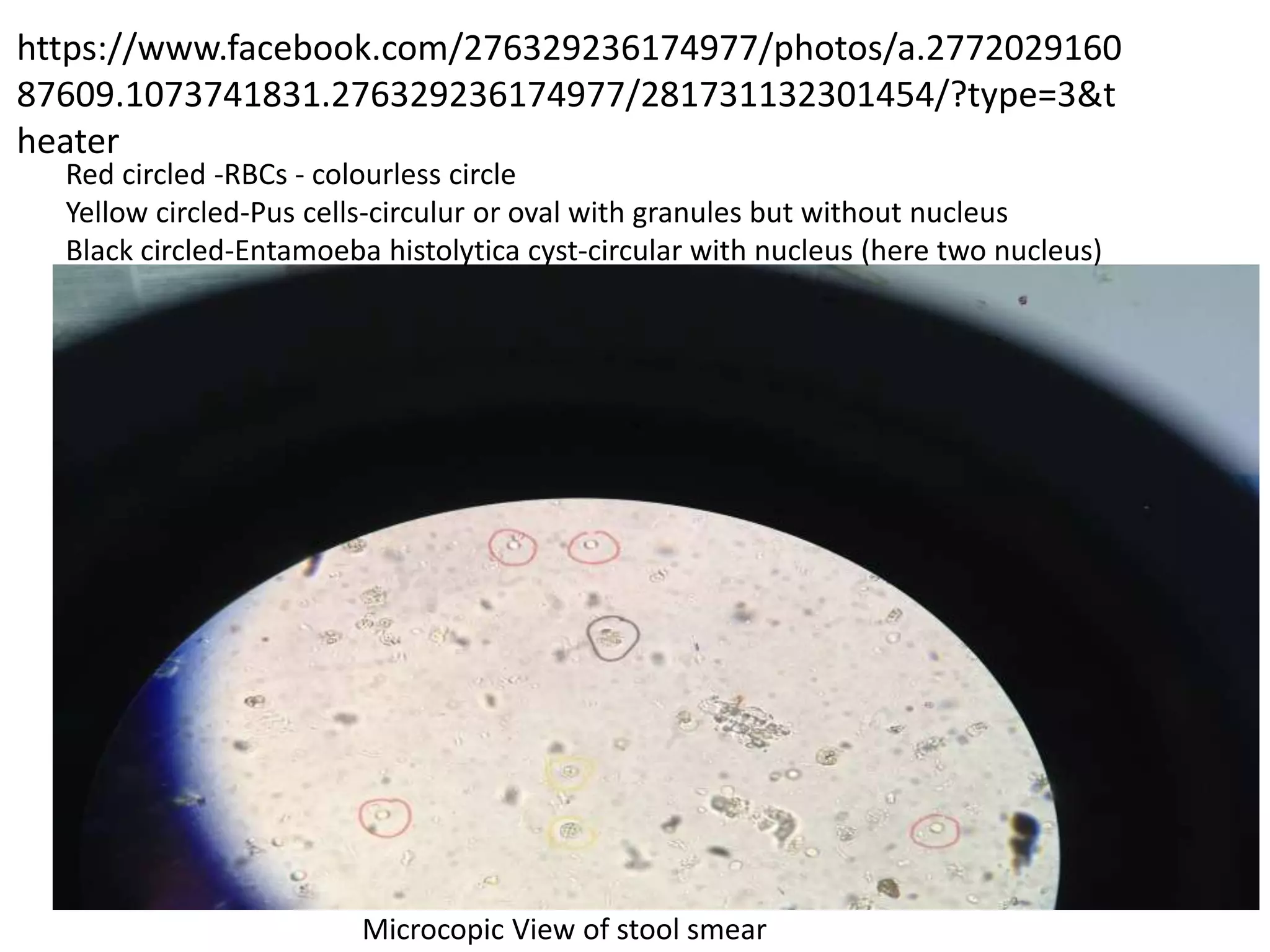 Differences between amoebic and bacillary dysentery | PPTX