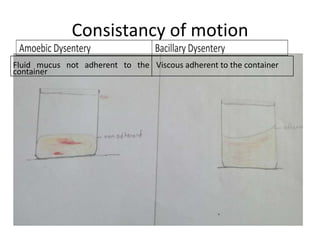 Differences between amoebic and bacillary dysentery | PPTX