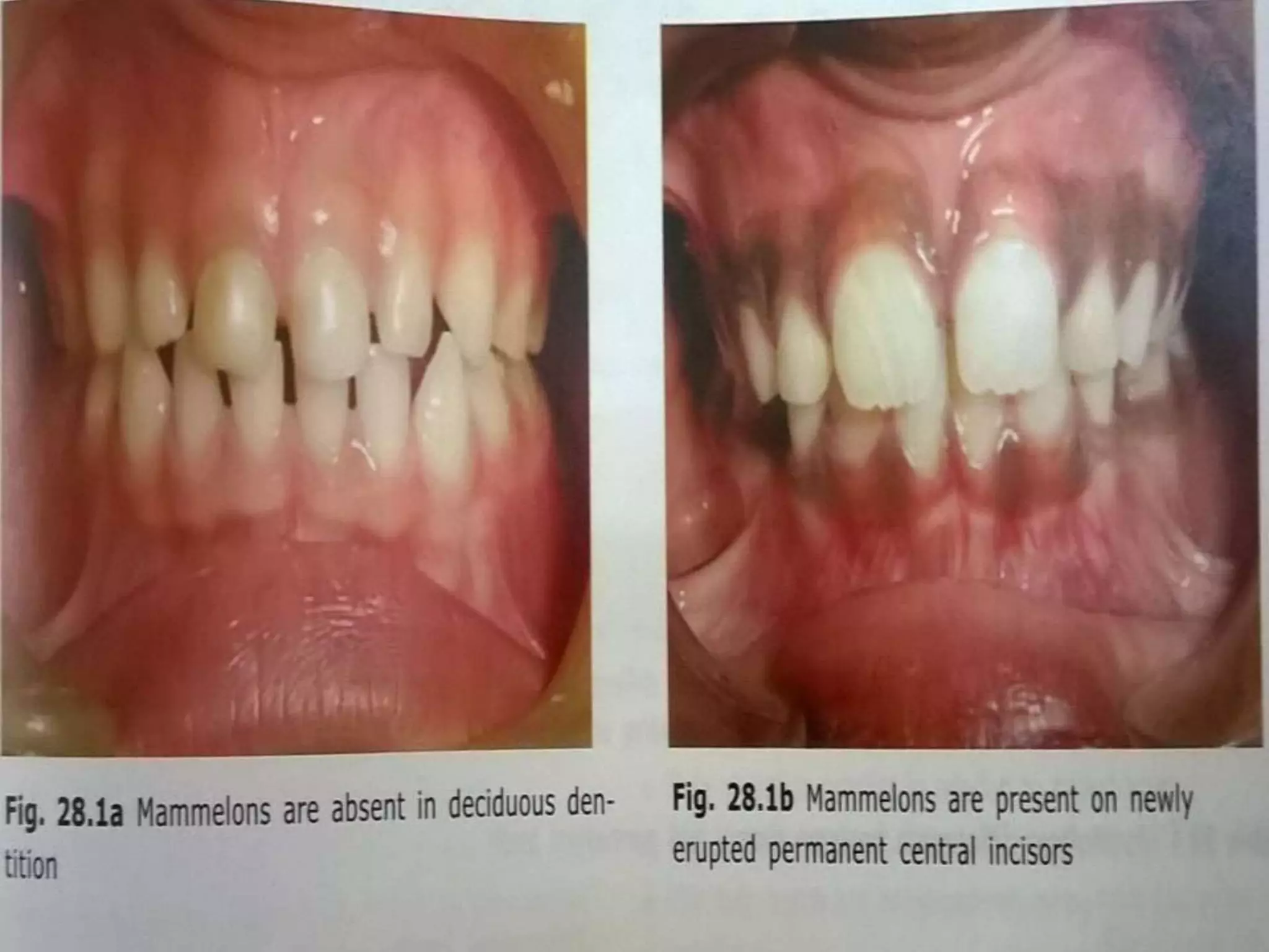 Differences between primary and permanent teeth | PPT Differences between primary and permanent teeth | PPT