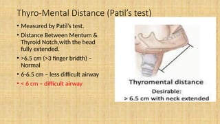 Different Airway Indices & implication for Prediction Of Difficult ...