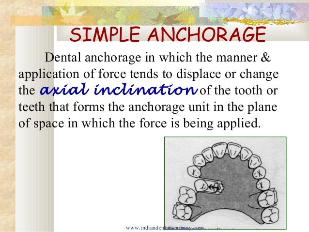 Different anchorage systems in orthodontics