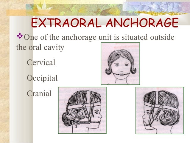 Different anchorage systems in orthodontics