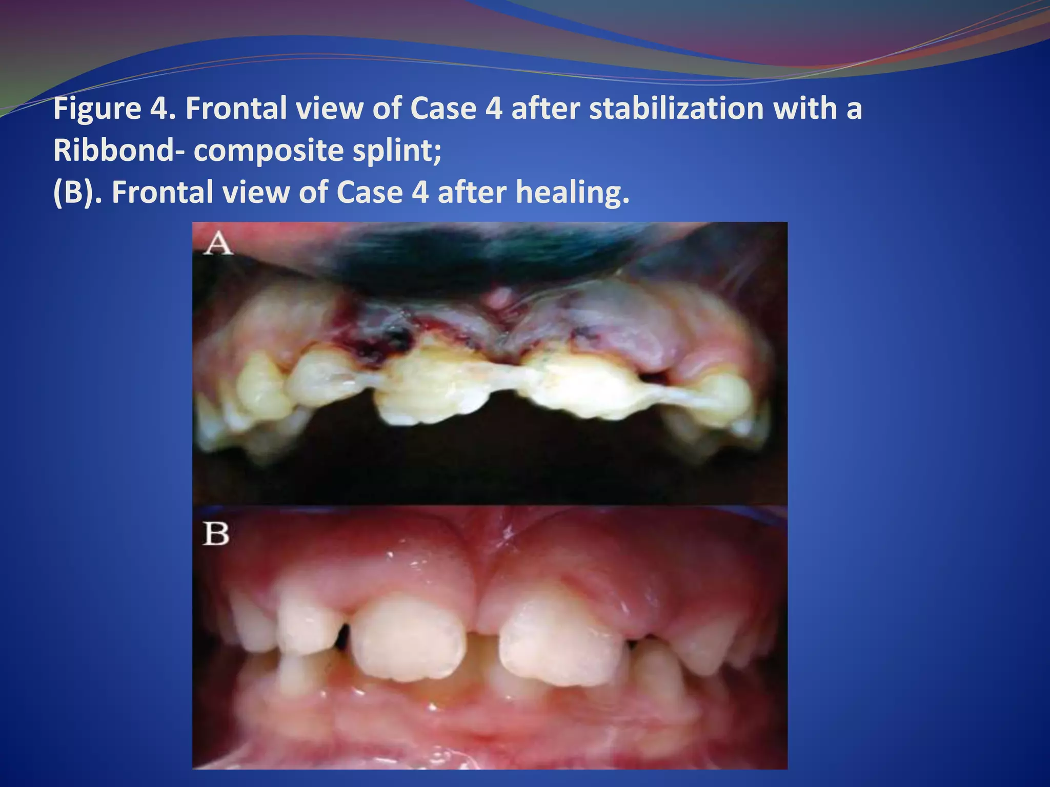 Different clinical applications of bondable reinforcement ribbond in ...