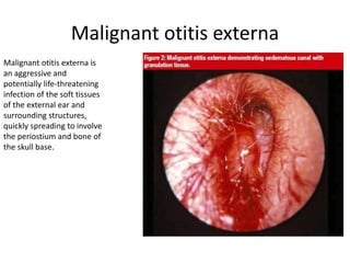 Malignant Otitis Externa Granulation Tissue