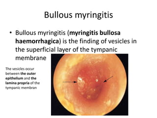 Bullous Myringitis