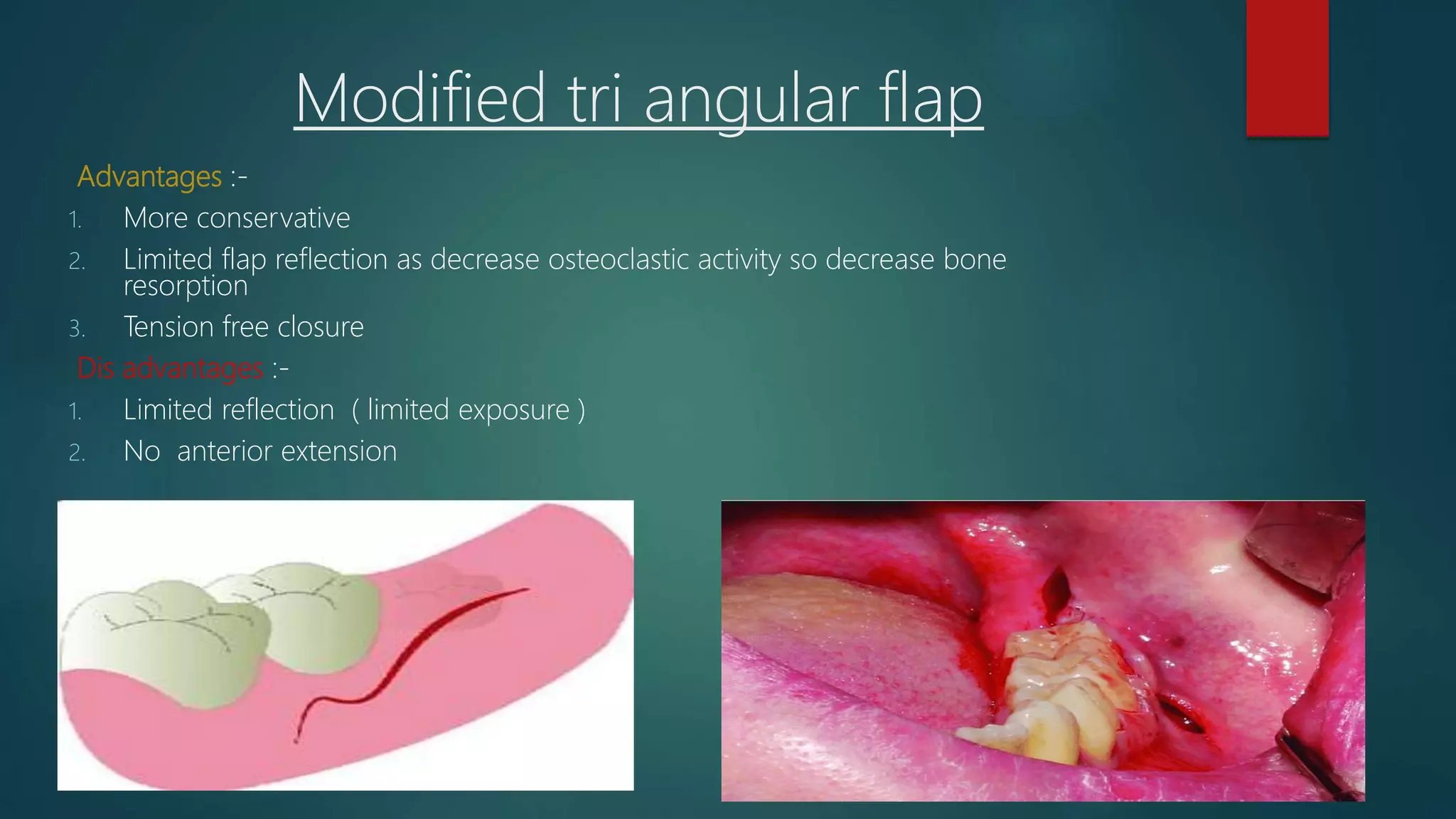 Different Flap Designs Used For The Management Of Impacted Wisdom Ppt