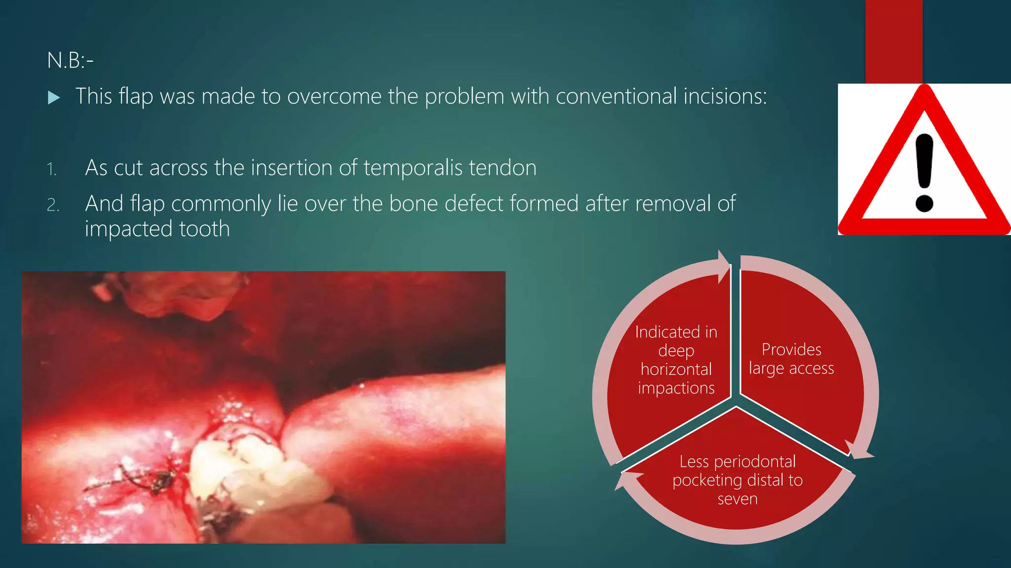 Different flap designs used for the management of impacted wisdom | PPTX