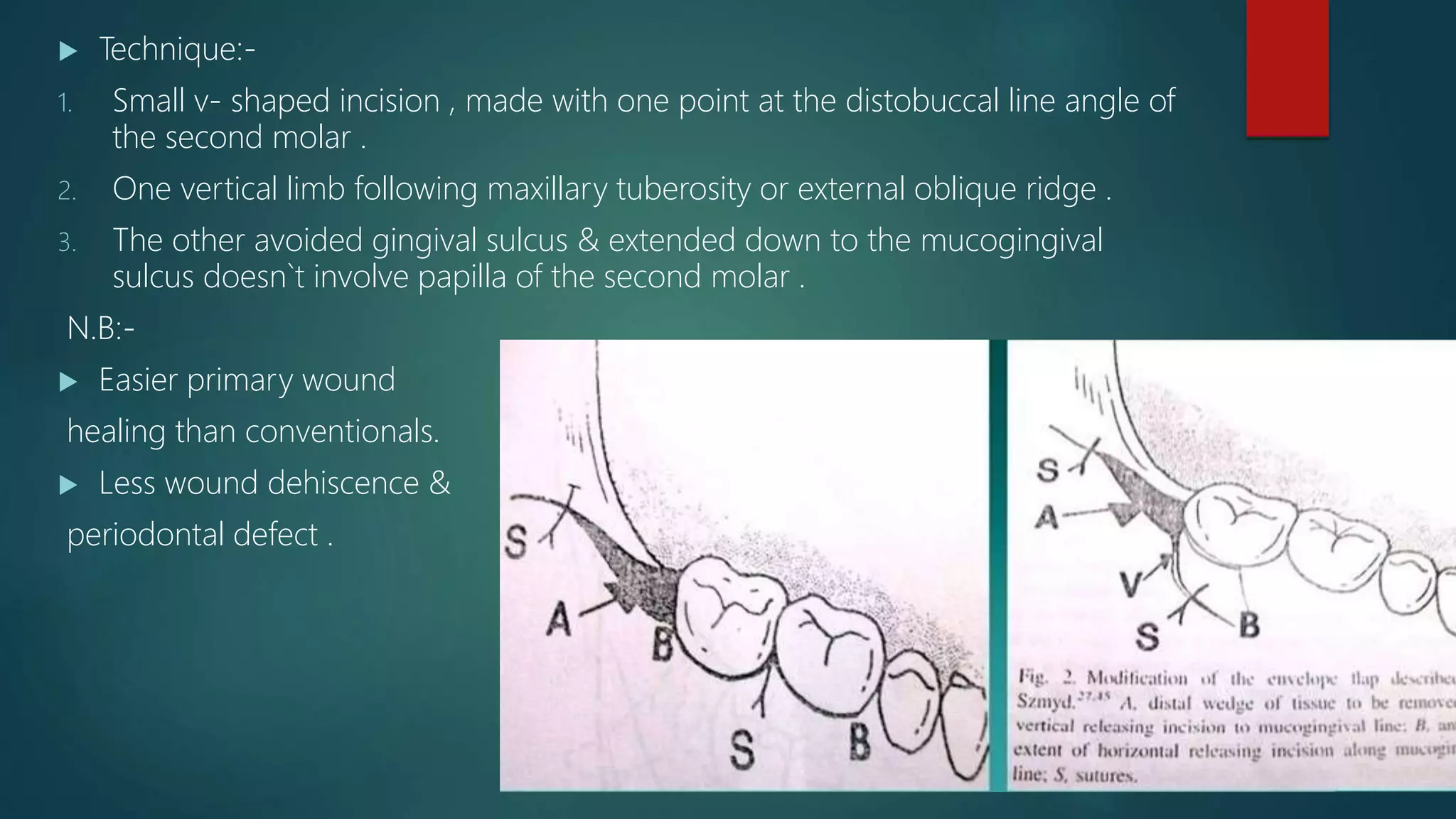 Different flap designs used for the management of impacted wisdom | PPTX