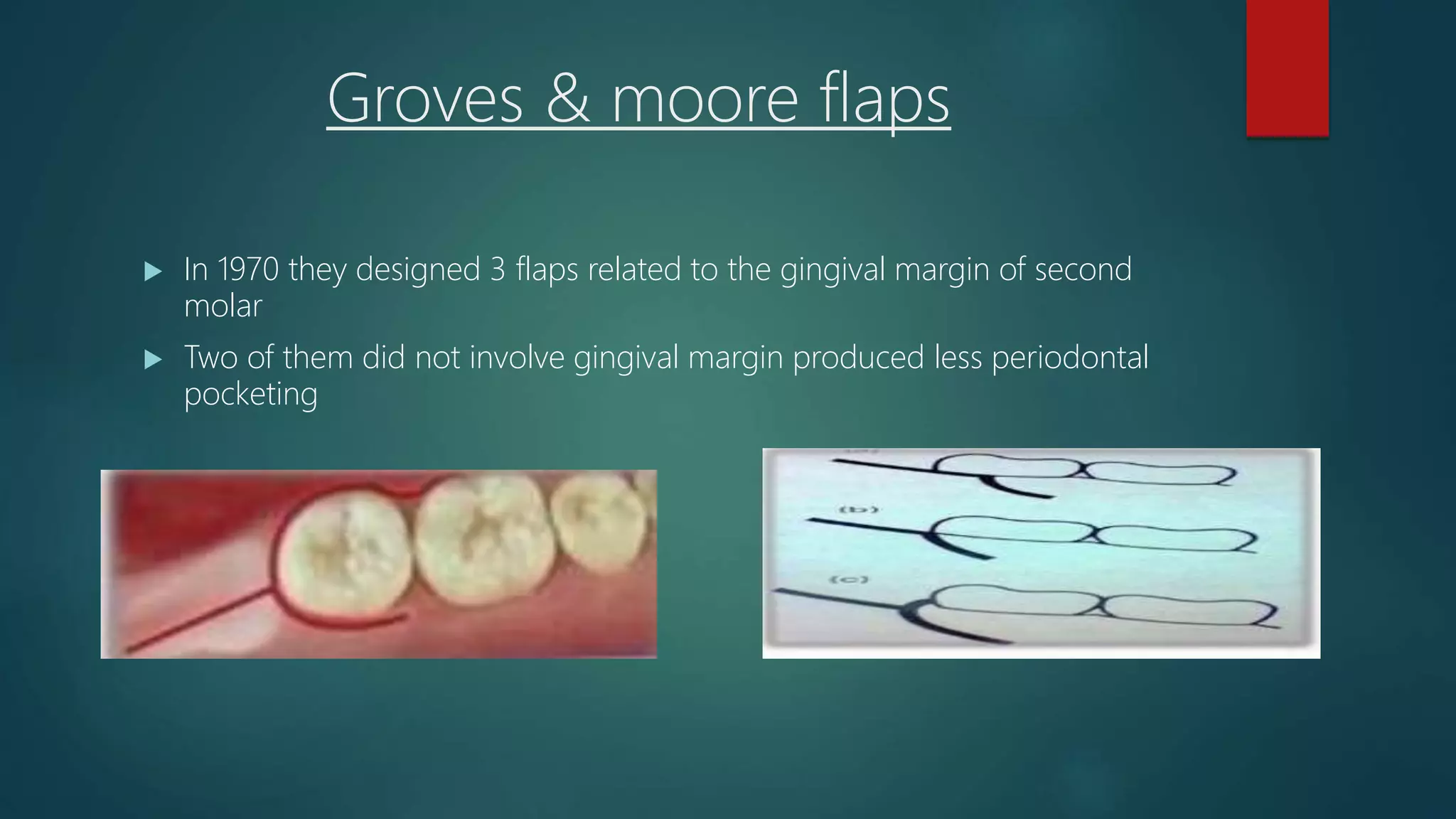 Different flap designs used for the management of impacted wisdom | PPTX