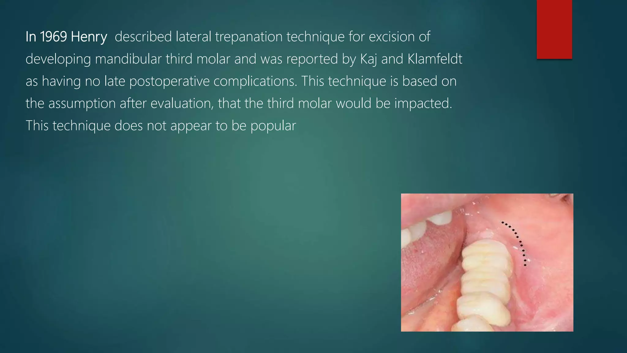 Different flap designs used for the management of impacted wisdom | PPTX