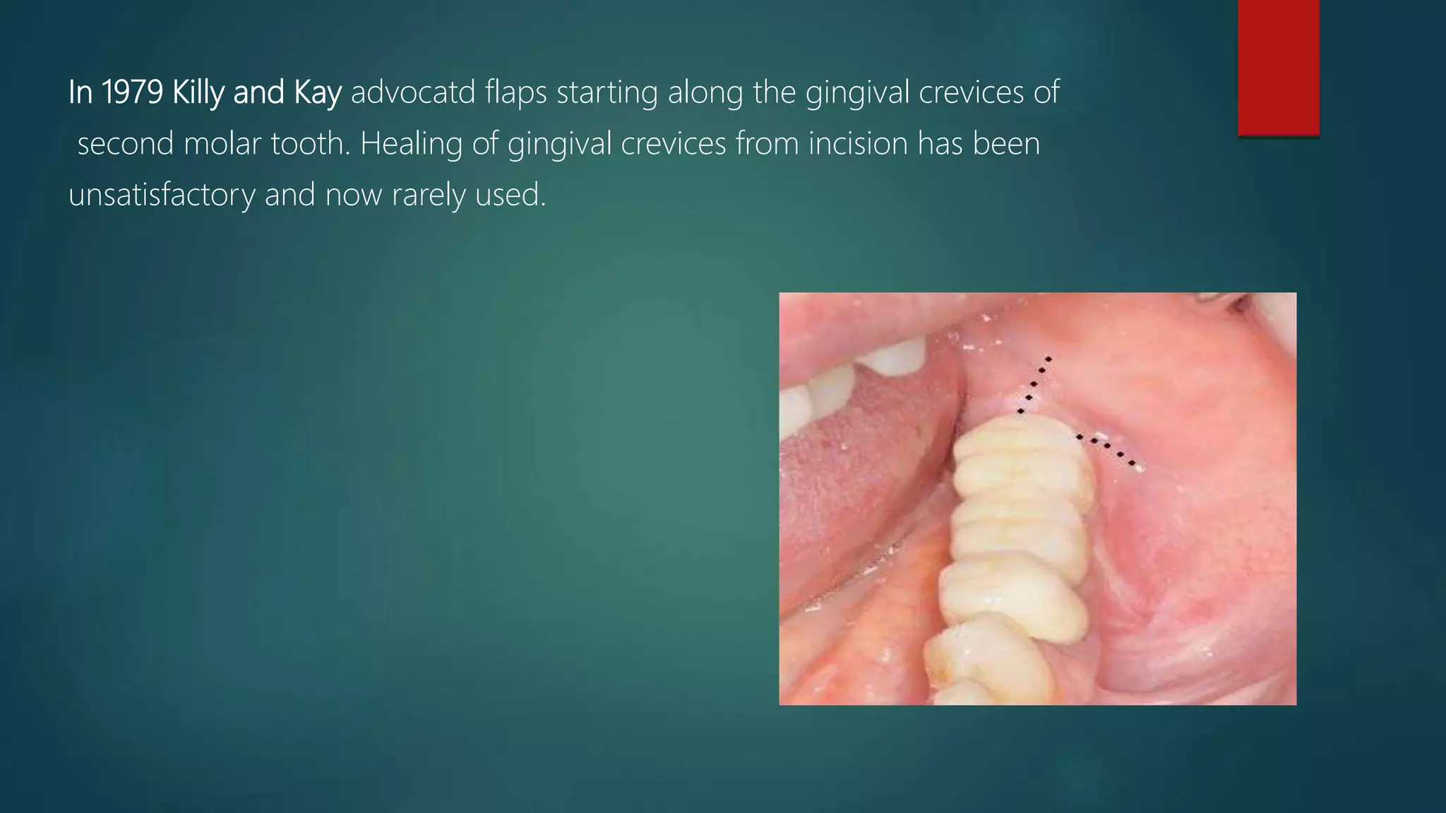Different flap designs used for the management of impacted wisdom | PPTX