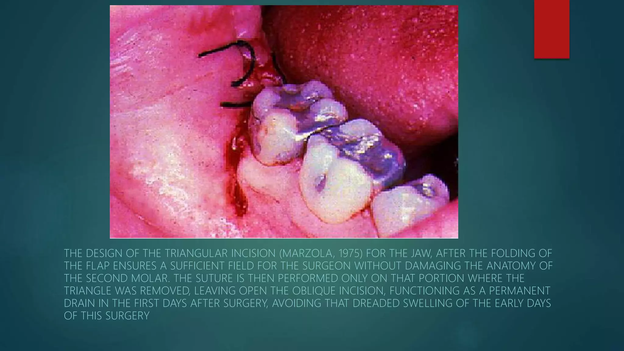 Different flap designs used for the management of impacted wisdom | PPTX