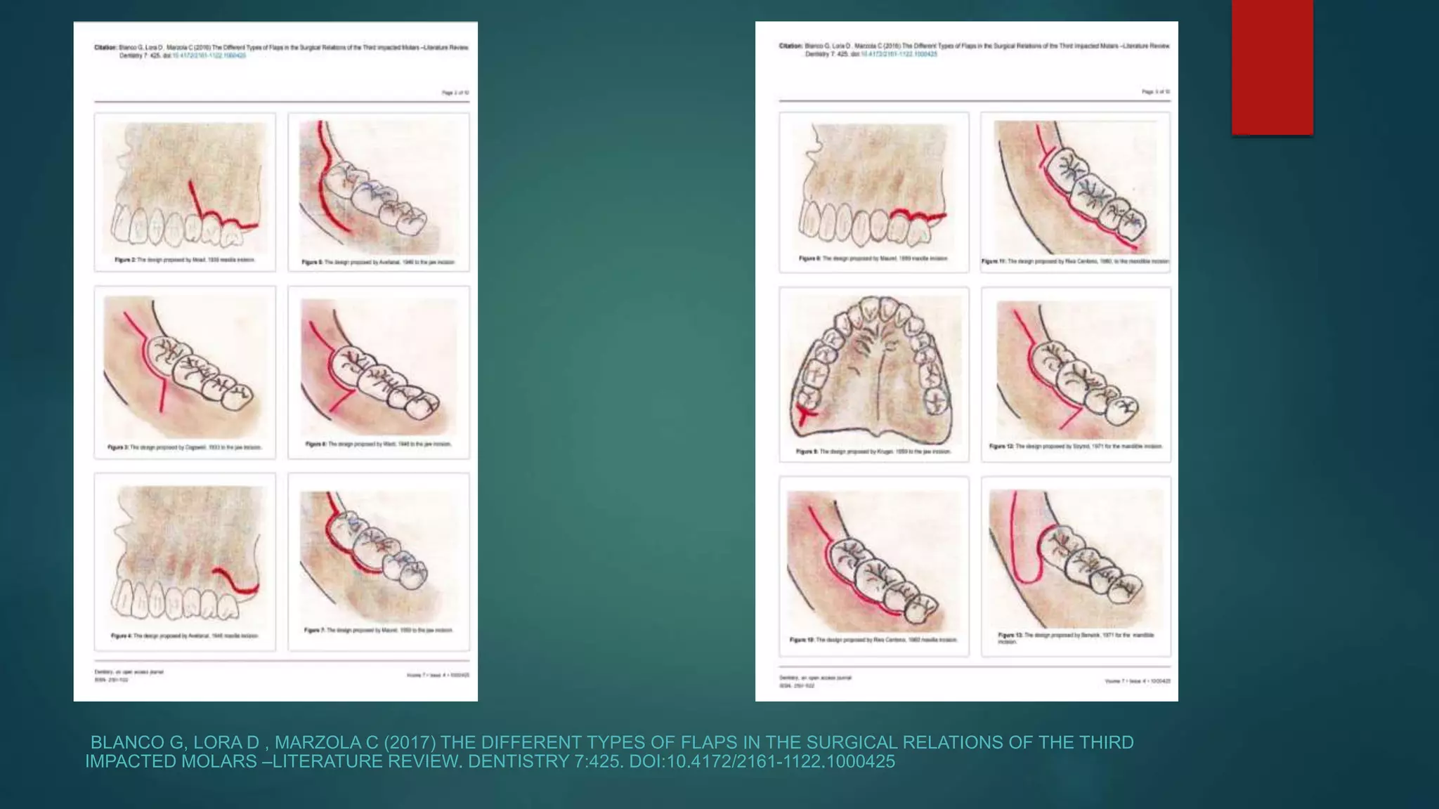 Different flap designs used for the management of impacted wisdom | PPTX