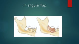 Different flap designs used for the management of impacted wisdom | PPTX