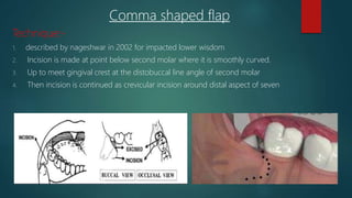 Different flap designs used for the management of impacted wisdom | PPTX