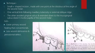 Different flap designs used for the management of impacted wisdom | PPTX