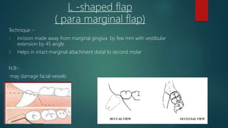 Different flap designs used for the management of impacted wisdom | PPTX