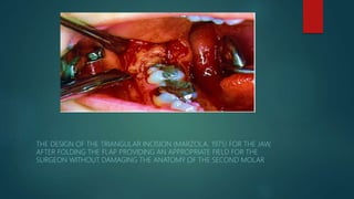 Different flap designs used for the management of impacted wisdom | PPTX
