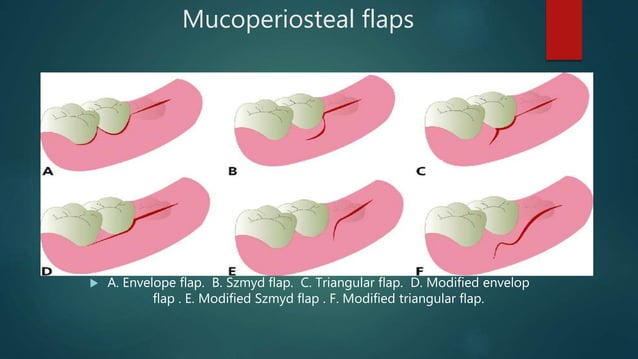 Different flap designs used for the management of impacted wisdom ...