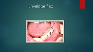 Different flap designs used for the management of impacted wisdom | PPTX
