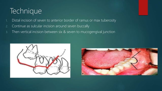 Different flap designs used for the management of impacted wisdom