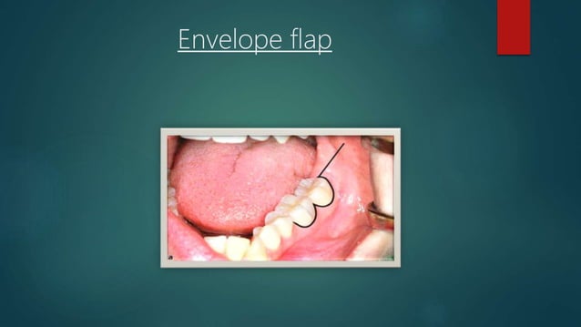 Different Flap Designs Used For The Management Of Impacted Wisdom