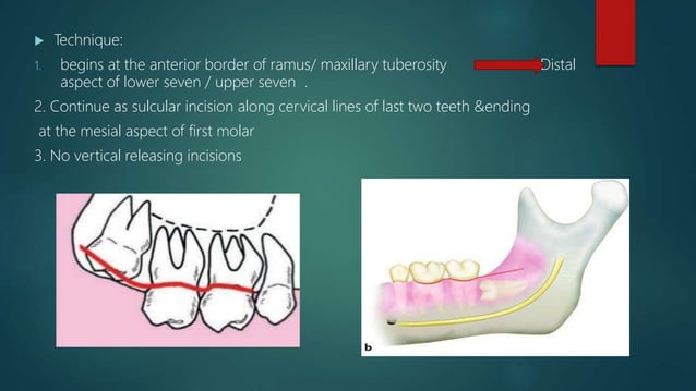 Different flap designs used for the management of impacted wisdom