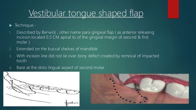 Different Flap Designs Used For The Management Of Impacted Wisdom