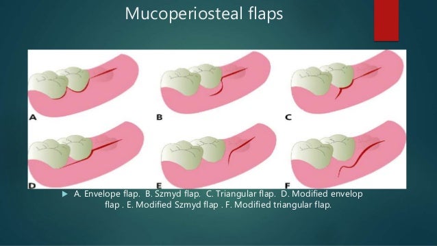 Different flap designs used for the management of impacted wisdom