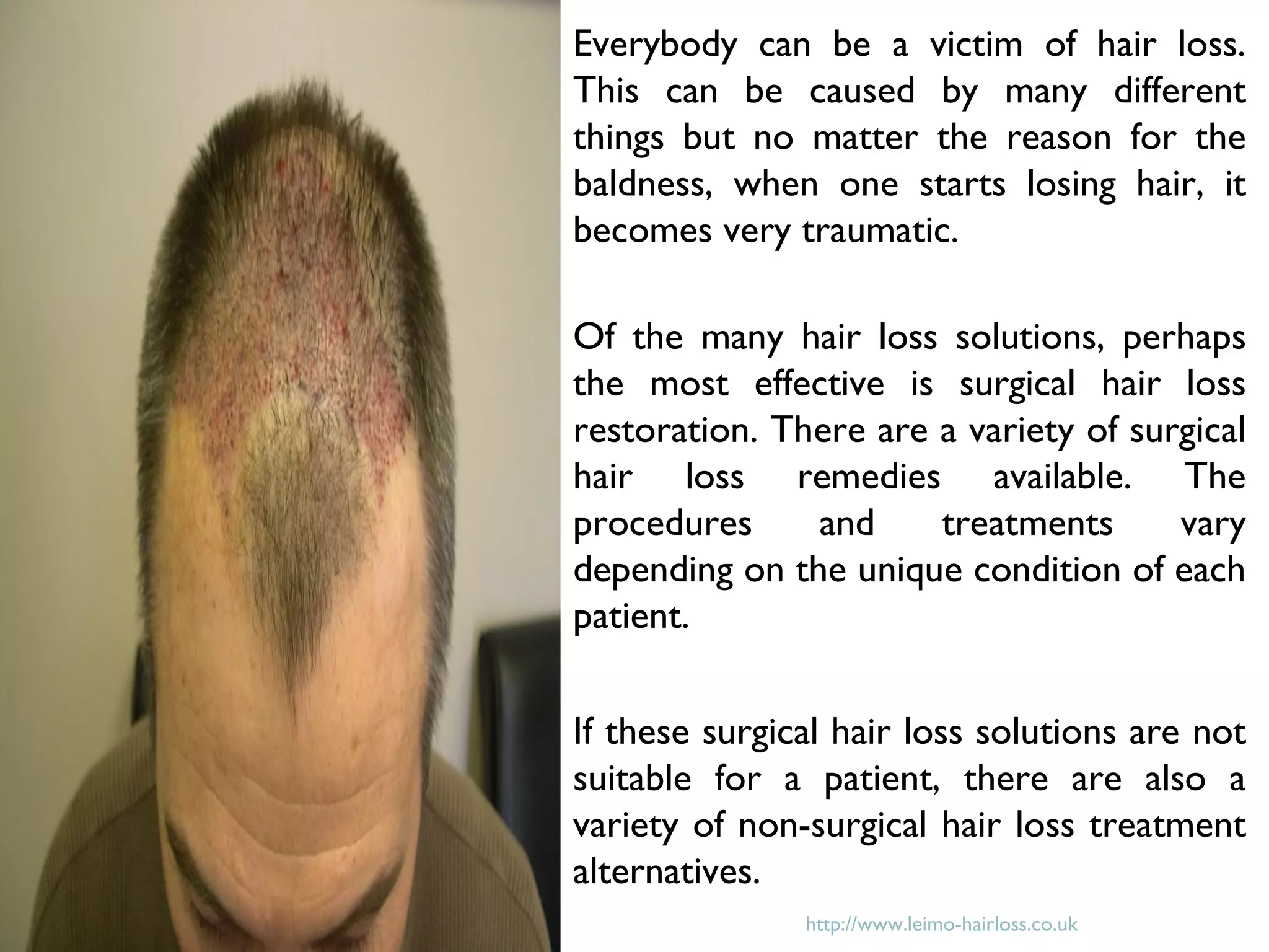 Different Hair Loss Restoration Methods Ppt