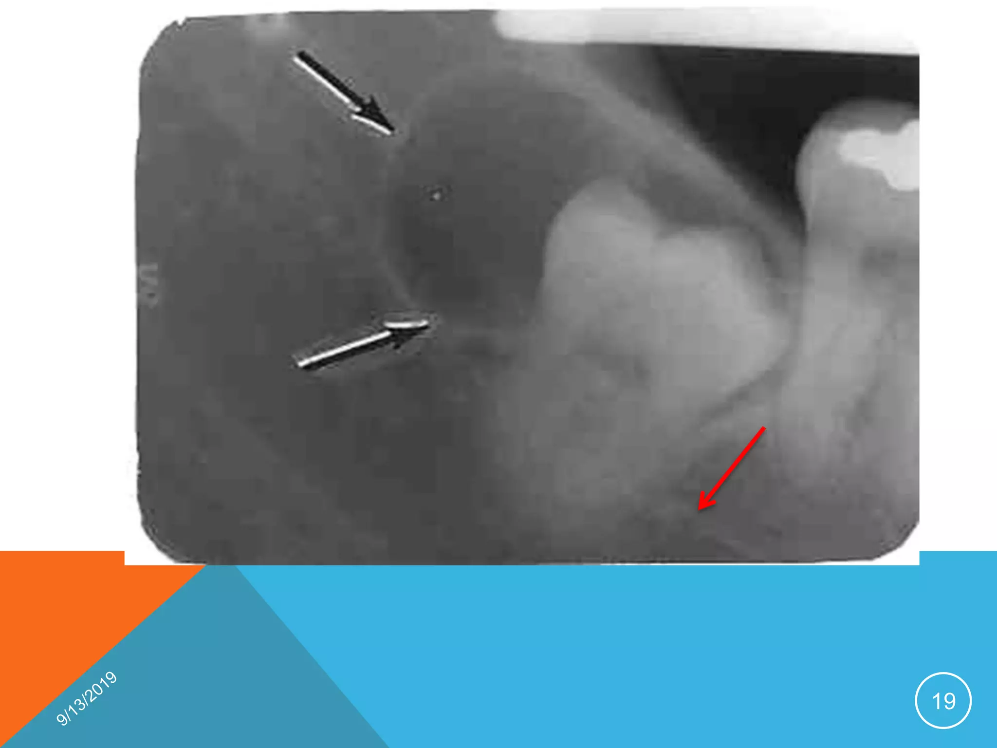 Differential diagnoses and management of mandibular radiolucent lesions ...