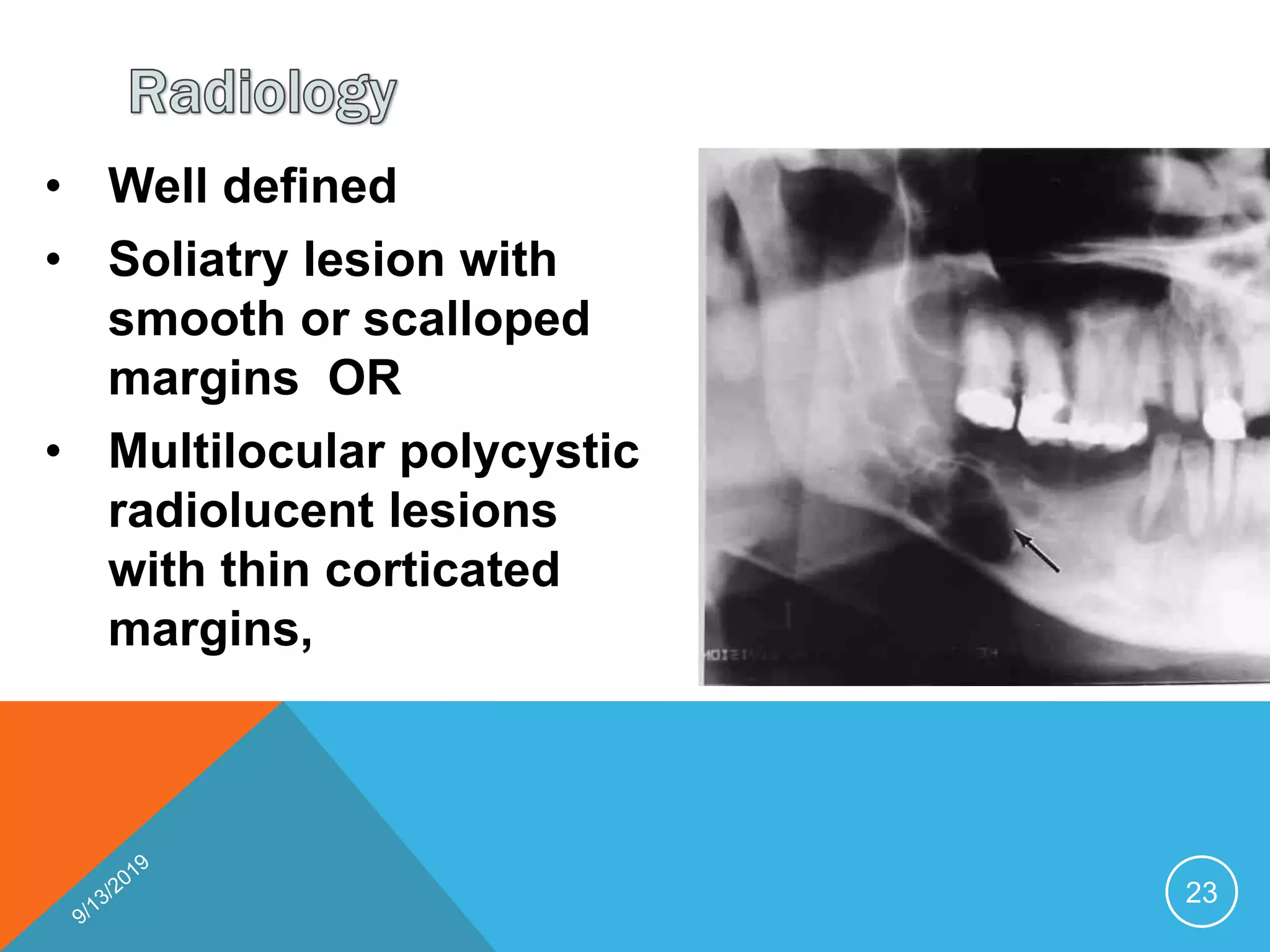 Differential diagnoses and management of mandibular radiolucent lesions ...