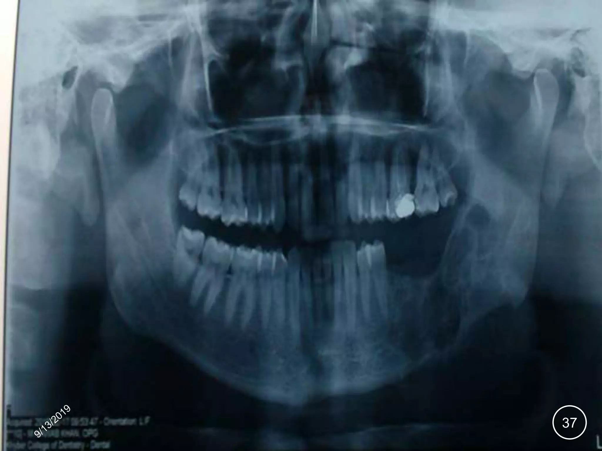 Differential diagnoses and management of mandibular radiolucent lesions ...