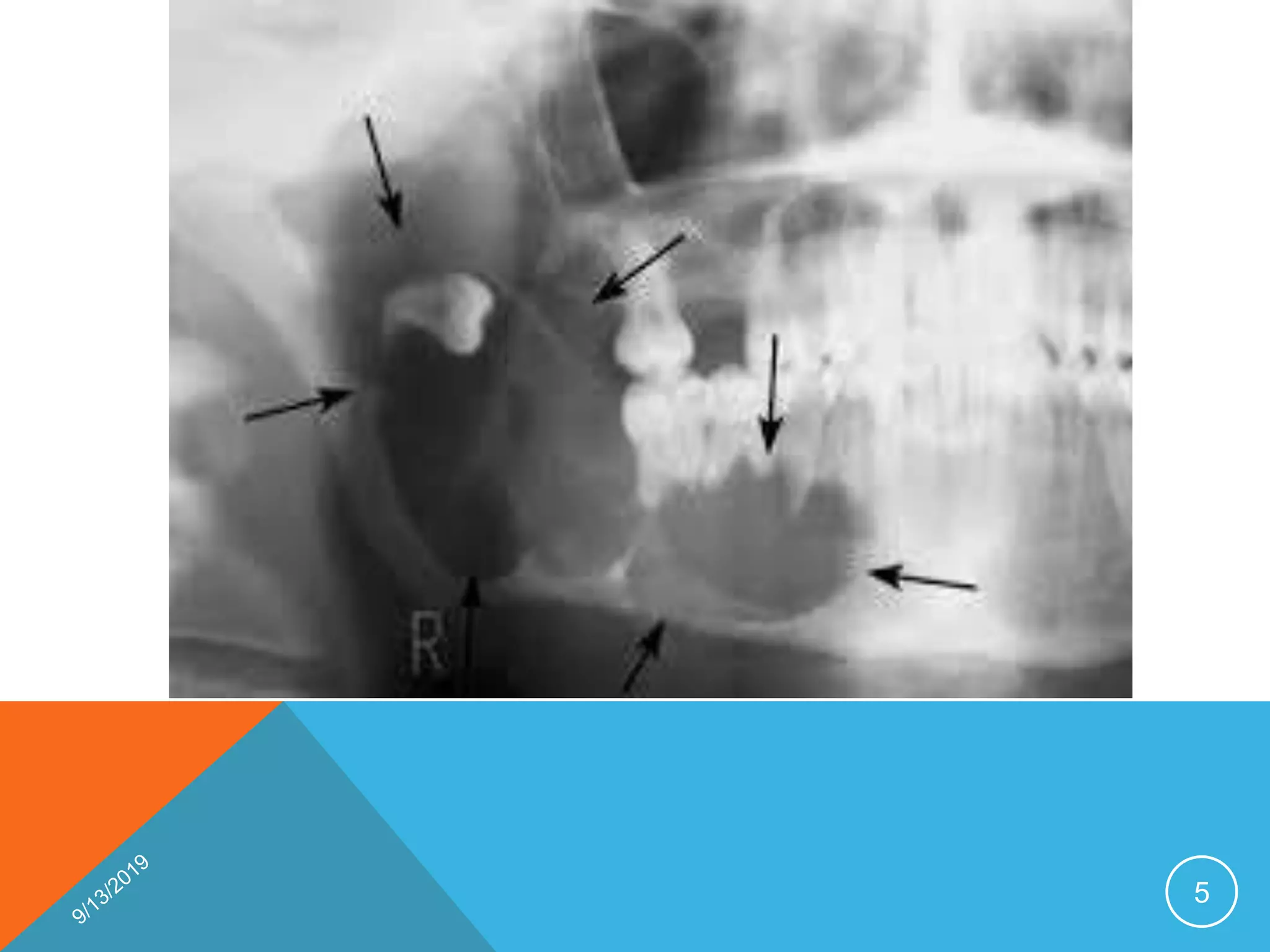 Differential diagnoses and management of mandibular radiolucent lesions ...