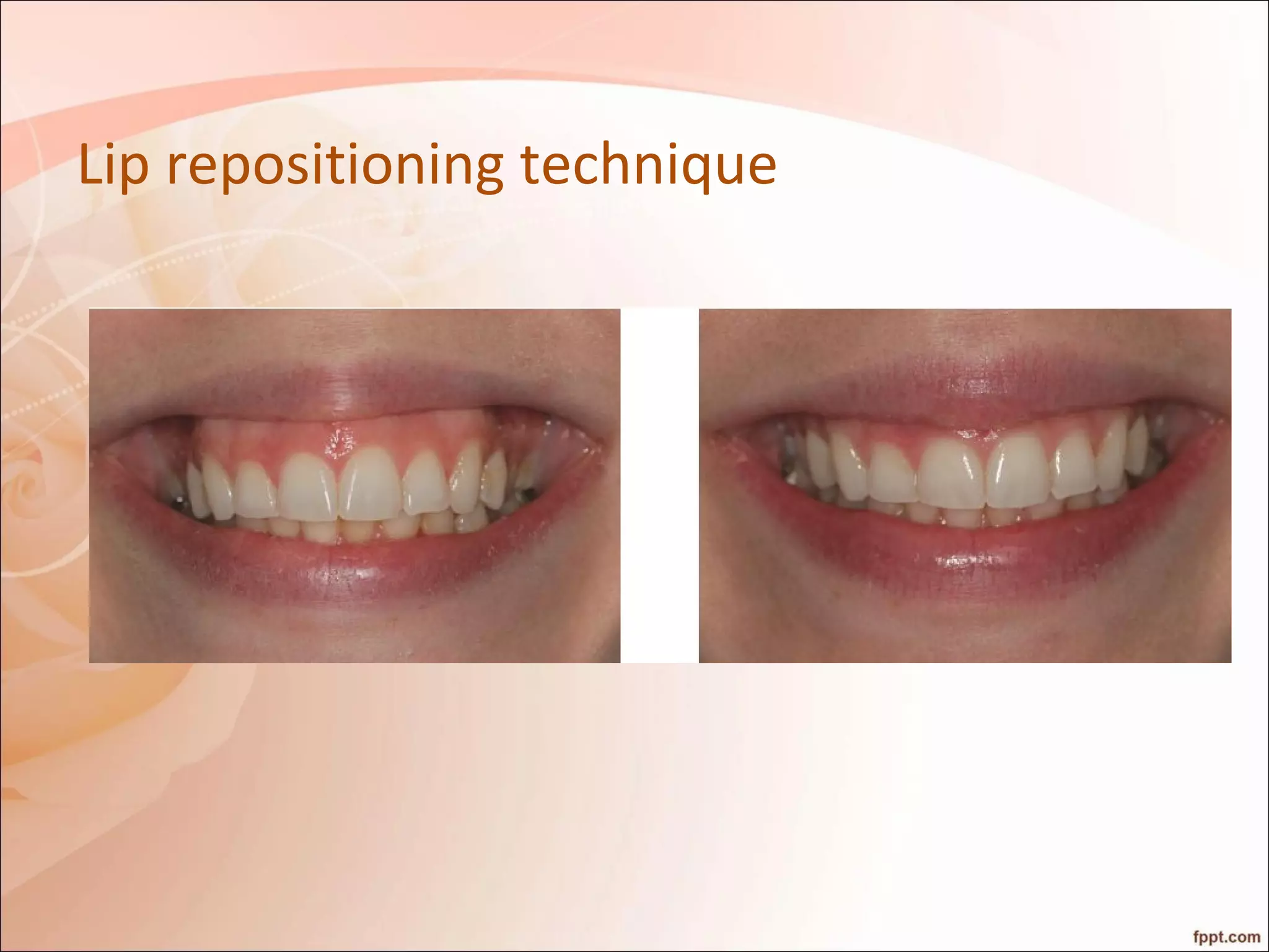 Differential diagnosis and management of gummy smile | PPT