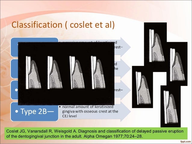 Differential diagnosis and management of gummy smile
