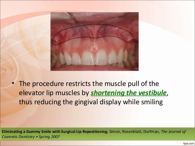 Differential diagnosis and management of gummy smile