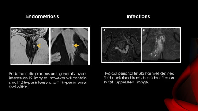 Differential Diagnosis for Anal and Perianal Masses.pptx